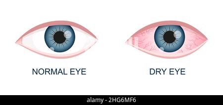 Uveitis symptoms or Eye Inflammation Stock Vector Image & Art - Alamy
