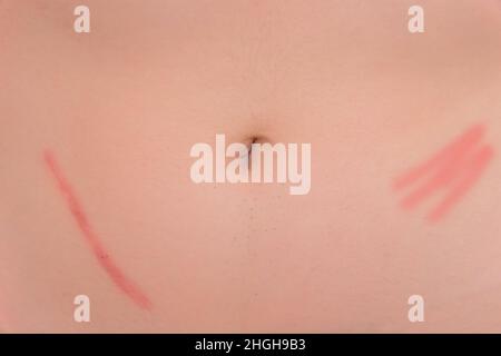 Body abdomen skin scar after removal of appendicitis surgery ...