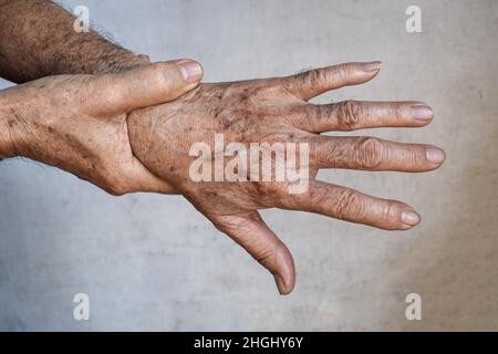 Age spots on the forearm and the hand of a 72-year-old woman Stock ...