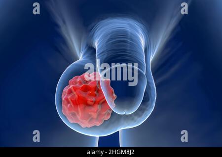 Testicular cancer, a malignant spermatocytic seminoma, computer ...