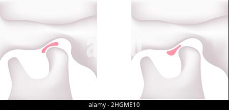 Illustration comparing the shapes of the articular disk ( normal jaw ...