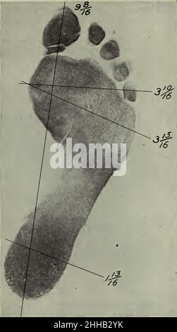 Soldiersfootmili00munsrich Fig14 Footprint of the same foot as shown in ...