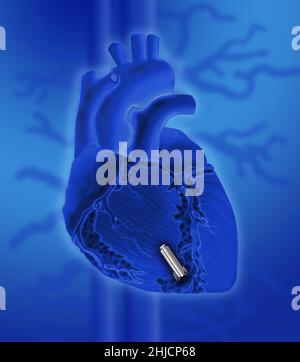 Leadless Pacemaker, Illustration Stock Photo - Alamy