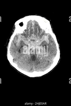 Subarachnoid haemorrhage, CT scan Stock Photo - Alamy