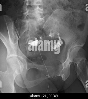 Blocked fallopian tube, X-ray Stock Photo - Alamy