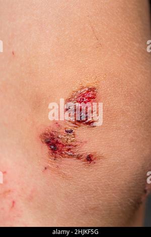 Children injury. Deep scratches on the skin on the kids elbow hand ...