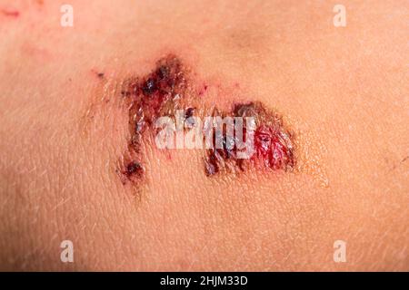 Wounds, scratches and abrasions on skin of child leg. Children injury ...