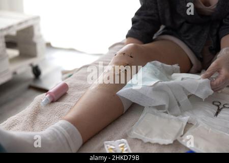 Close up shot of an ACL surgery with a young woman changing her bandage ...