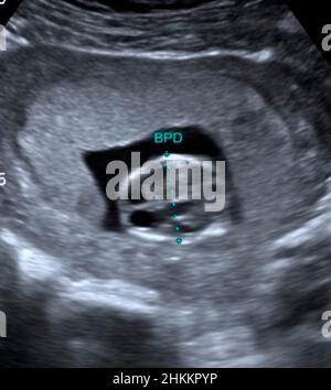 Foetal measurement, ultrasound scan Stock Photo - Alamy
