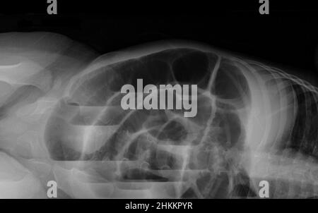Intussusception of the intestines, X-ray Stock Photo - Alamy