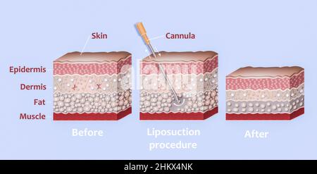 Mechanism of liposuction. Suction-assisted liposuction. Hollow tube or ...
