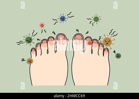Onychomycosis. Vector illustration Stock Vector Image & Art - Alamy