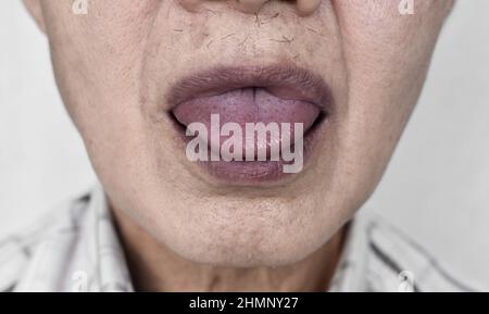 Cyanotic lips or central cyanosis at Southeast Asian elder man with ...