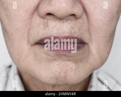 Cyanotic lips or central cyanosis at Southeast Asian elder man with ...