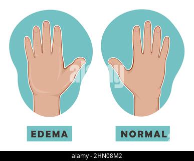 Edema swollen hand or arm. Lymphedema, eodema disease vector. Cartoon ...