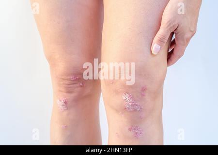 Swelling of the knee with effusion (fluid in the joint) in a 50 year ...