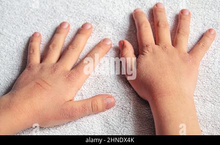 Red spots on the skin of the child's hands.children's allergy.selective ...
