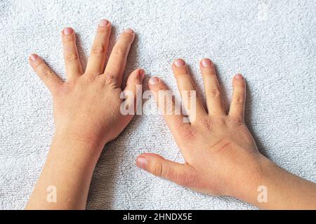 Red spots on the skin of the child's hands.children's allergy.selective ...