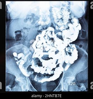 Barium study of small bowel after sixty minutes Stock Photo - Alamy