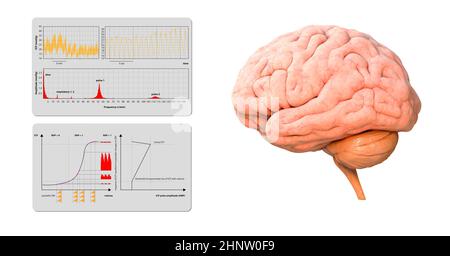 Intracranial Pressure Monitoring ICP waveform, 3d render, 2d graphic ...