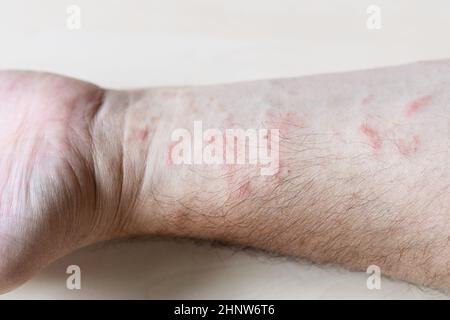 sample of Allergic contact dermatitis - side of male shin with itchy ...