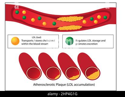 Blood clot in damaged blood vessel made of red blood cells, platelets ...