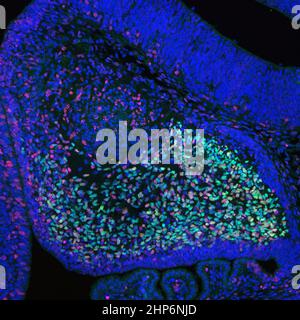 Close-up of neurons in a mouse with Niemann-Pick type C1 ...