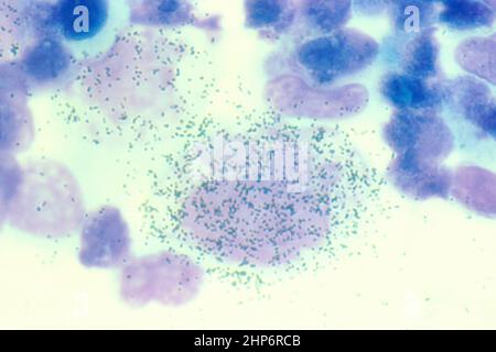 Histological slide of the human herpes virus-6 (HHV-6) previously known ...