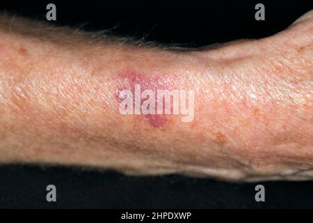 Purpura, senile purpura Stock Photo - Alamy