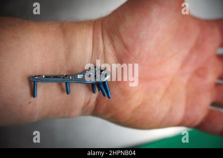 an explanted surgical blue titanium radius plate lies on the wrist ...
