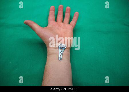 an explanted surgical blue titanium radius plate lies on the wrist ...