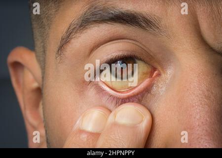 Closeup of yellow eye because of high bilirubin level, cirrhosis or ...