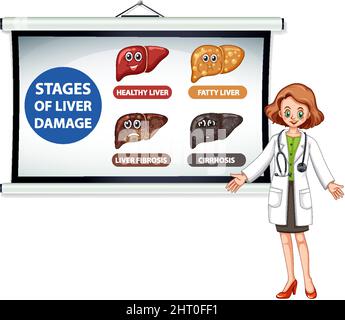 Diagram showing stages of liver damage illustration Stock Vector Image ...