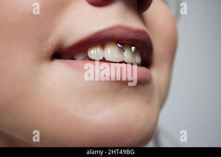 smile or frenulum piercing under the upper lip Stock Photo - Alamy