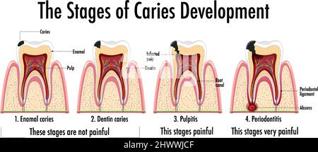 Infographic of human in stages of caries development illustration Stock ...