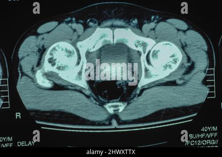 A scan of a woman's reproductive system Stock Photo - Alamy