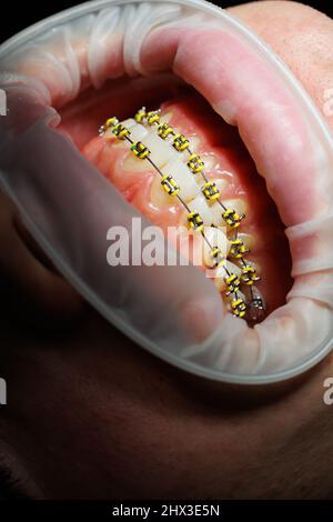 Extender for teeth. Teeth of a woman with braces at a dentist ...