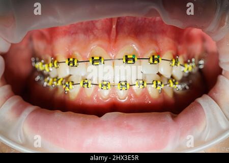 Extender for teeth. Teeth of a woman with braces at a dentist ...