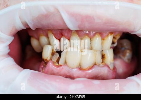 Spoiled teeth, poor dental hygiene, caries, Mouth disease. shattered ...