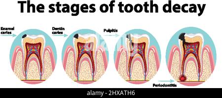 Infographic of human in the stages of tooth decay illustration Stock ...