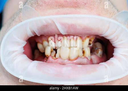 Spoiled teeth, poor dental hygiene, caries, Mouth disease. shattered ...