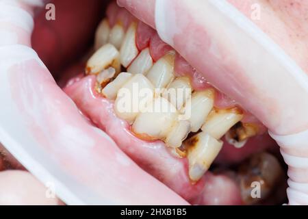 Spoiled teeth, poor dental hygiene, caries, Mouth disease. shattered ...