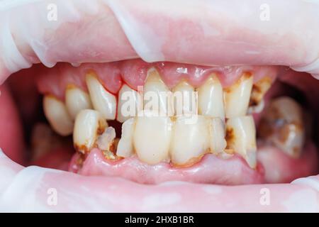 Spoiled teeth, poor dental hygiene, caries, Mouth disease. shattered ...