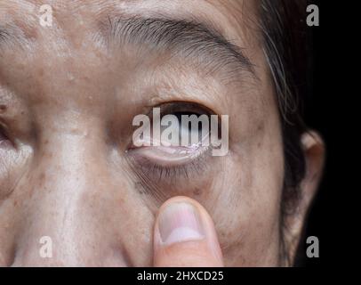 Pale skin of Asian elderly woman. Sign of anemia. Pallor at eyelid ...