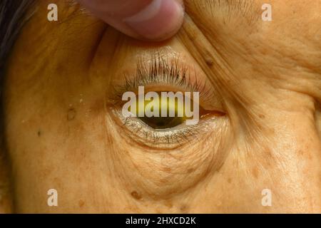 Deep jaundice in Asian female patient. Yellowish discoloration of skin ...