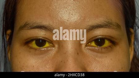 Deep jaundice in Asian female patient. Yellowish discoloration of skin ...