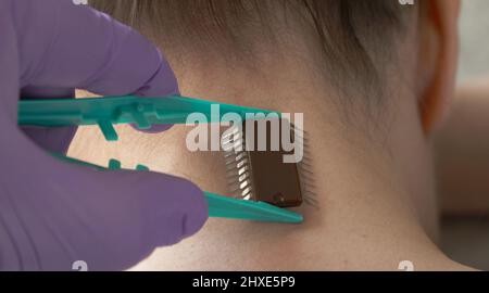implantation of chip under the human skin. microchip is connected to ...