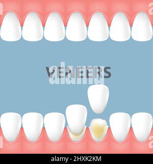 veneers teeth vector Stock Vector Image & Art - Alamy