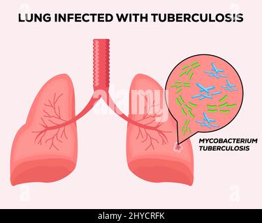 Lung infected with tuberculosis illustration Stock Vector Image & Art ...