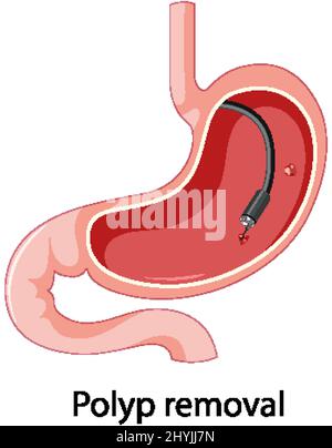 Diagram showing polyp removal illustration Stock Vector Image & Art - Alamy